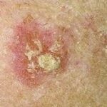 Skin cancer images | What does it look like? | Skin Cancer Clinic