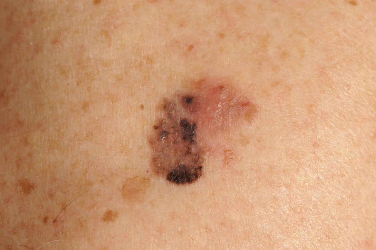 What Types Of Skin Cancer Are There Get The Answer Here