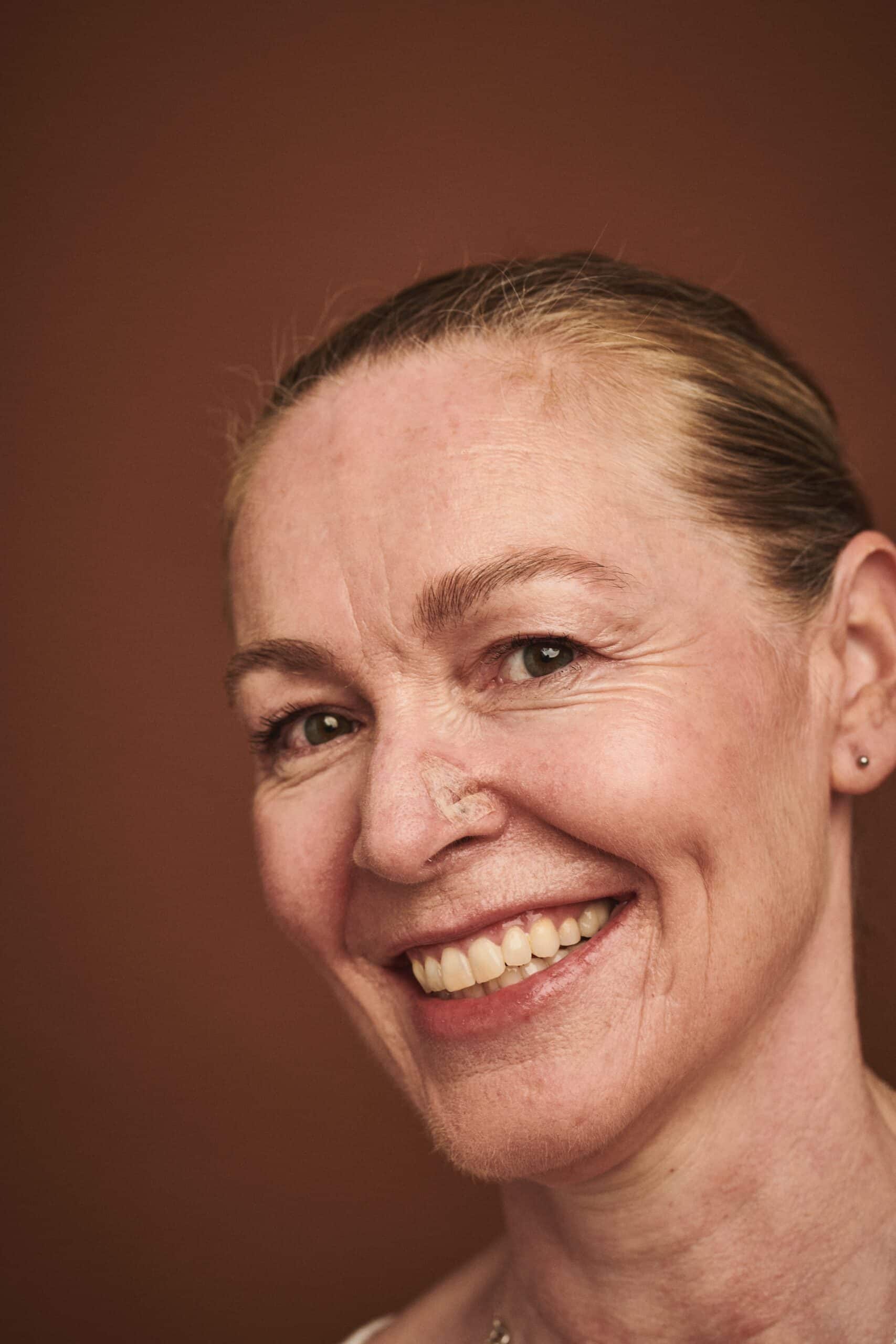 Bettina’s story - Hudkræftklinikken